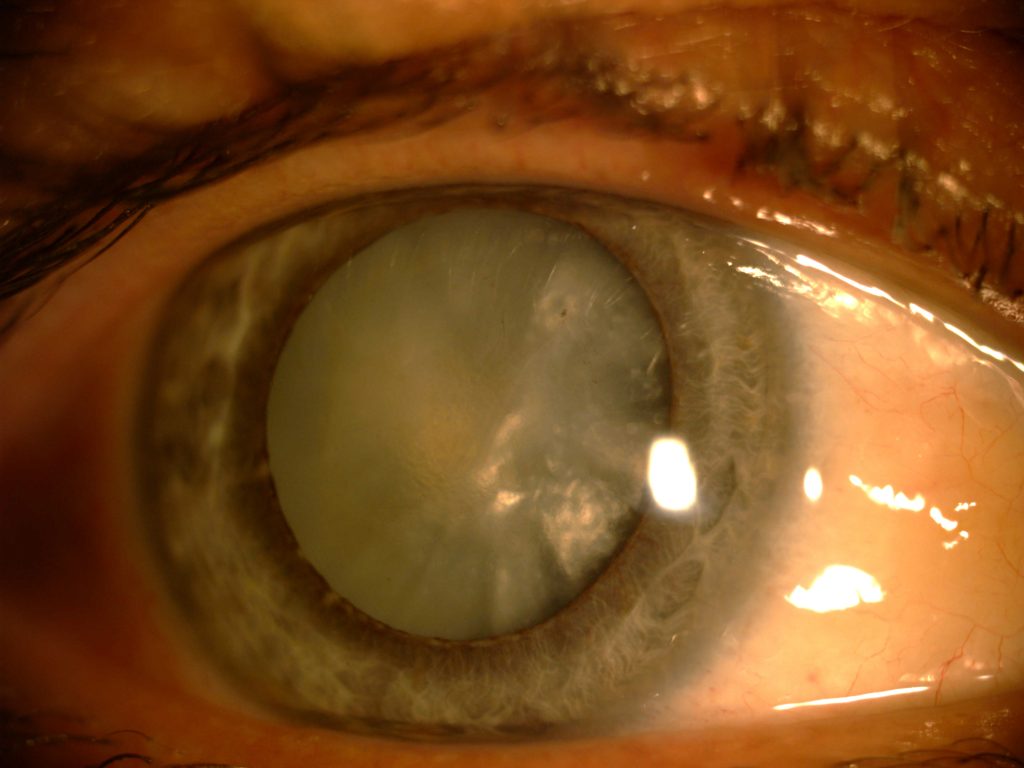 Katarakt Nedir? - Göz Hastalıkları & Üveit