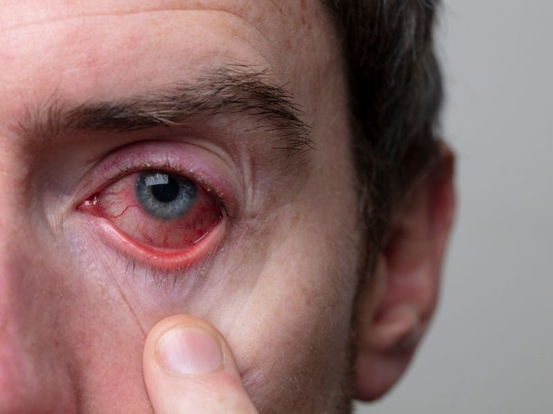 Romatizma ve Göz - Göz Hastalıkları ve Üveit Doktoru